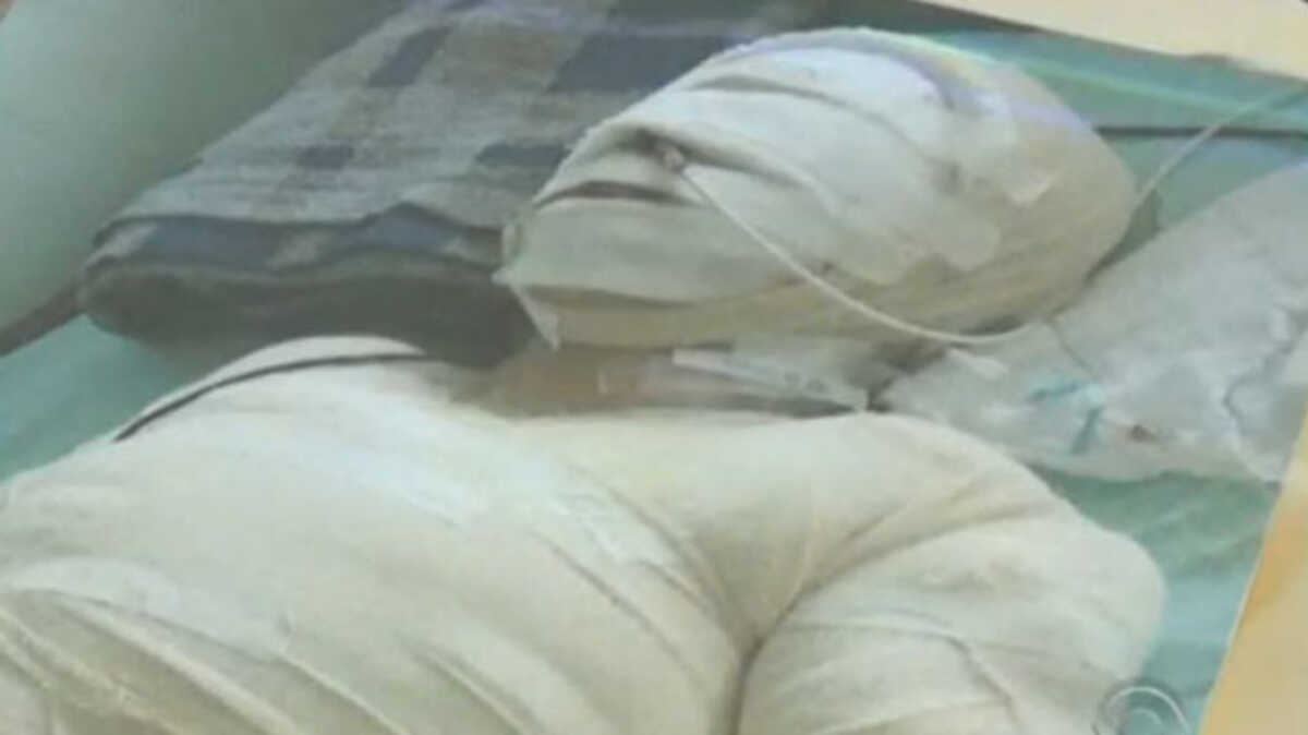 Queimada pelo ex com óleo e ácido está 9 nove meses internada e não irá ...